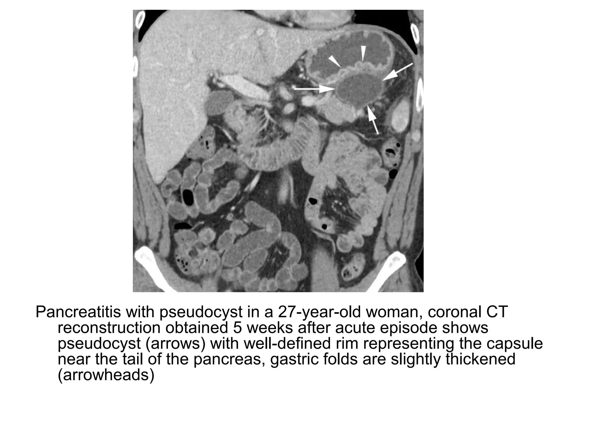 Diagnostic Imaging of Pancreatitis | PPT