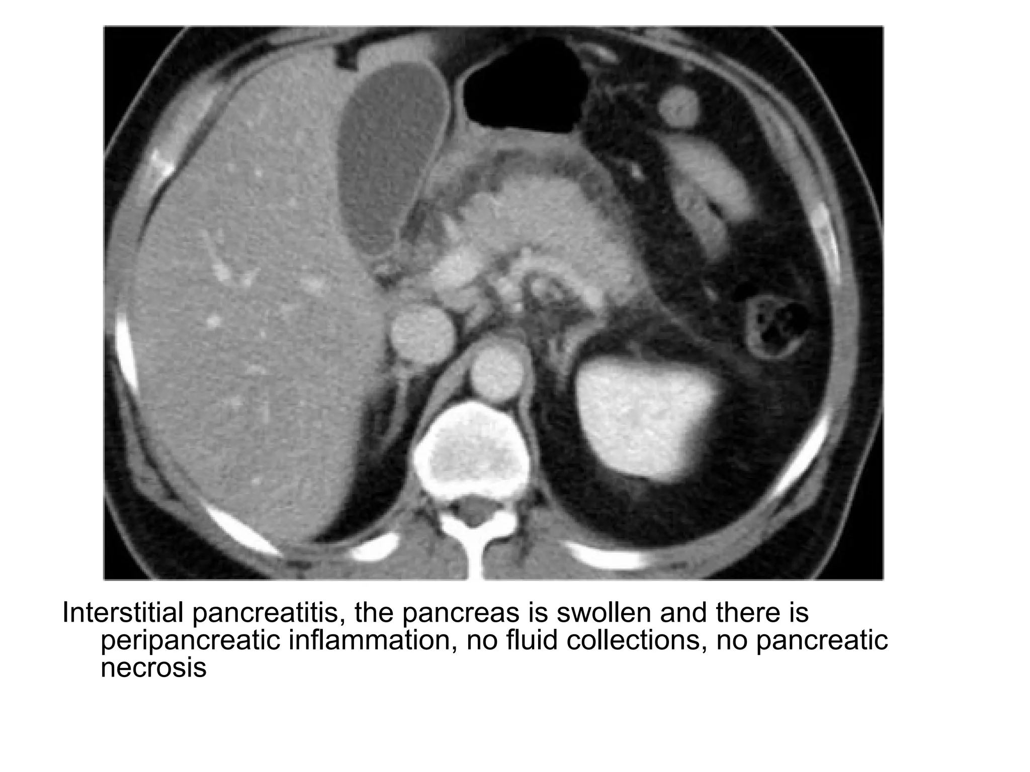 Diagnostic Imaging of Pancreatitis | PPT