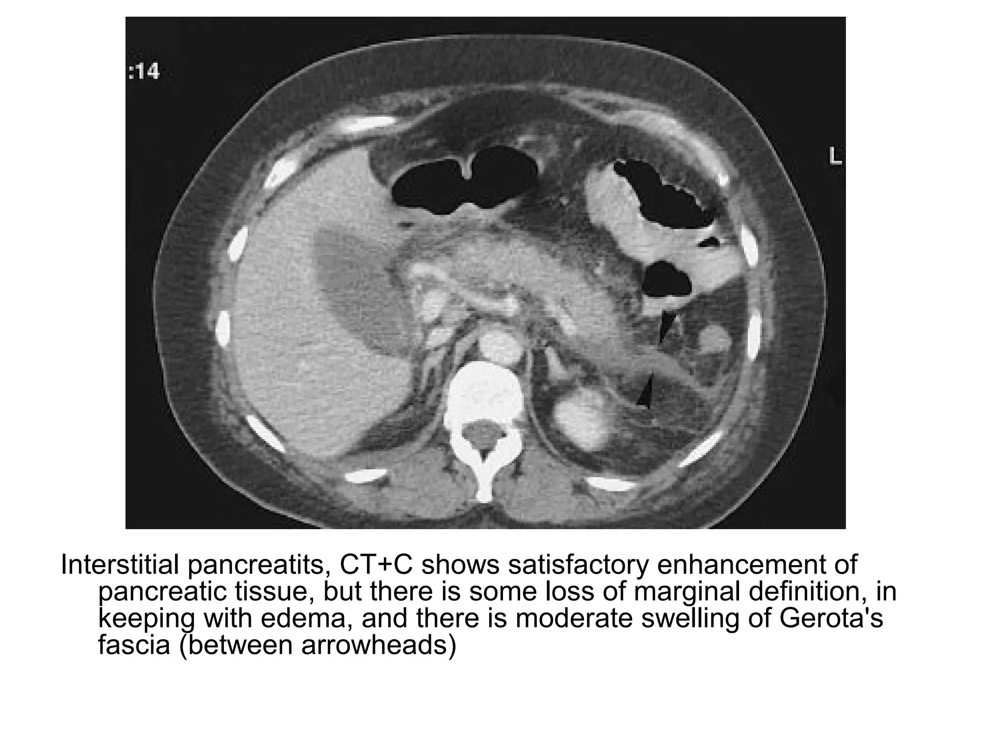 Diagnostic Imaging of Pancreatitis | PPT