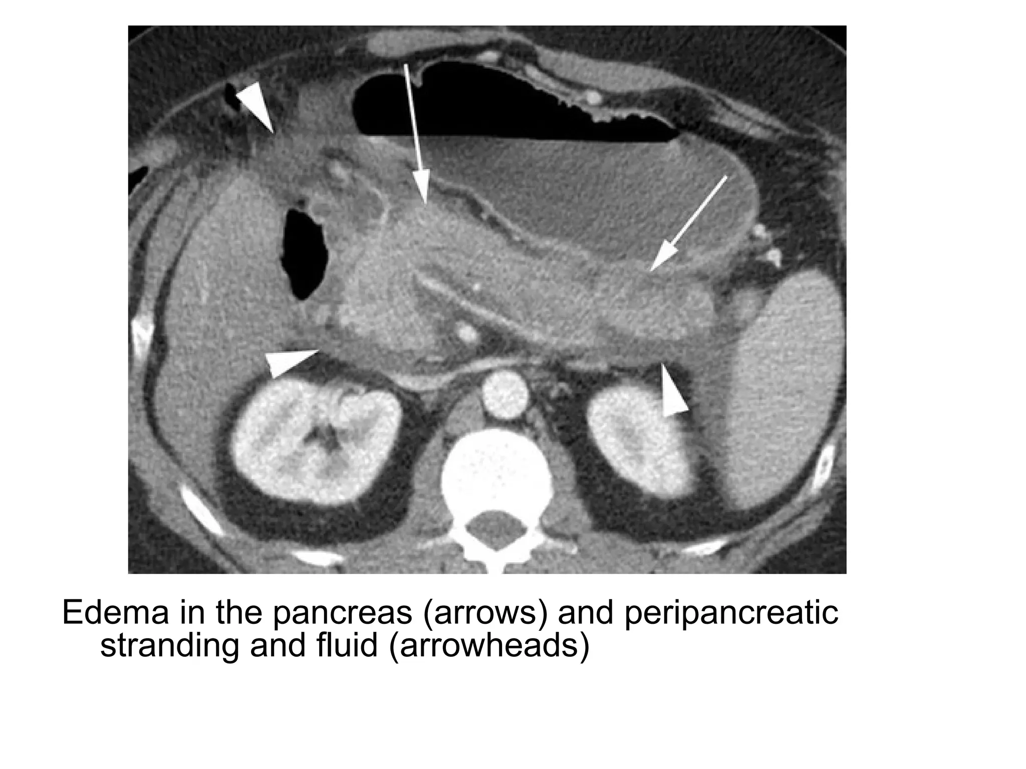 Diagnostic Imaging of Pancreatitis | PPT