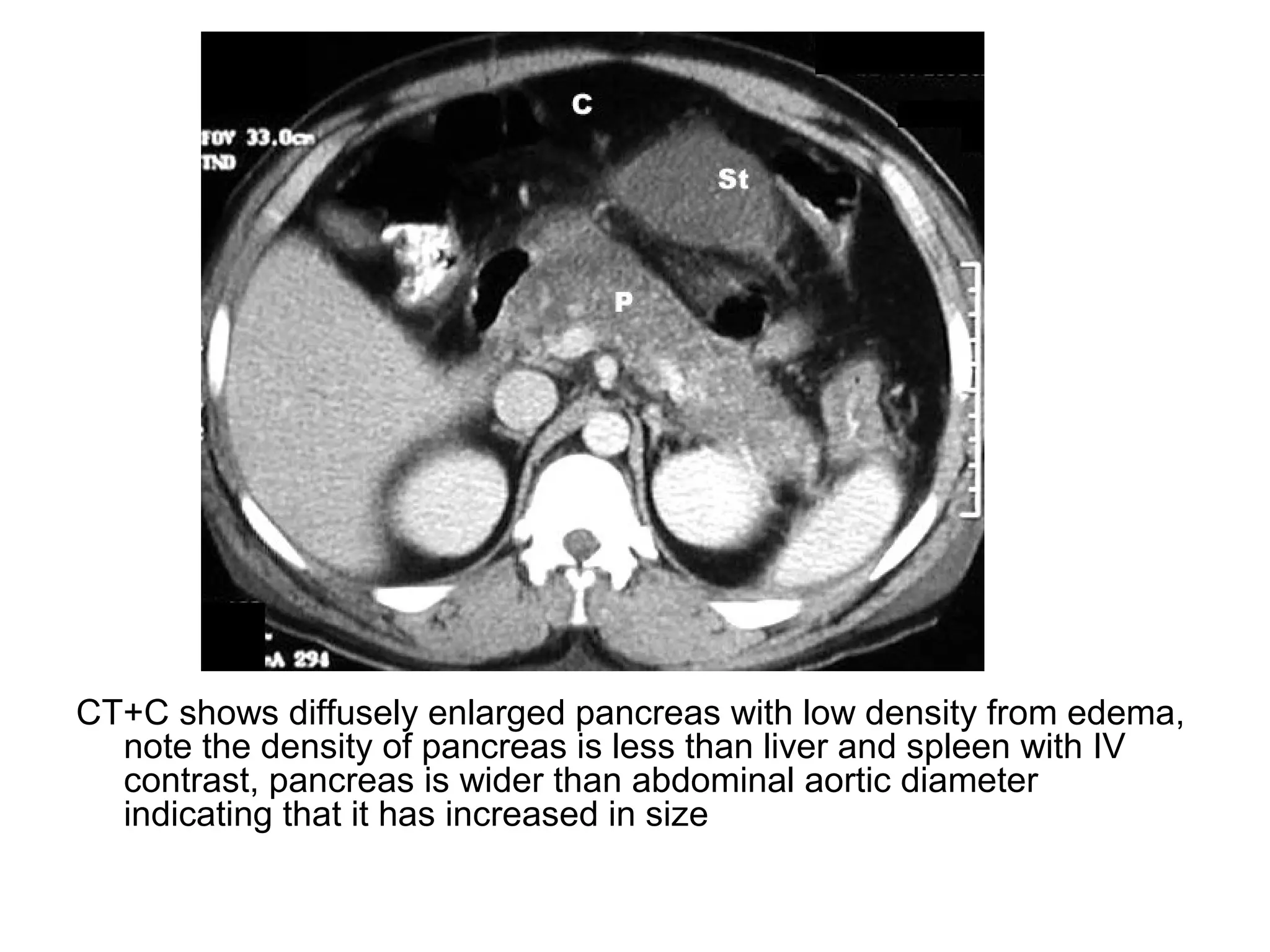 Diagnostic Imaging of Pancreatitis | PPT