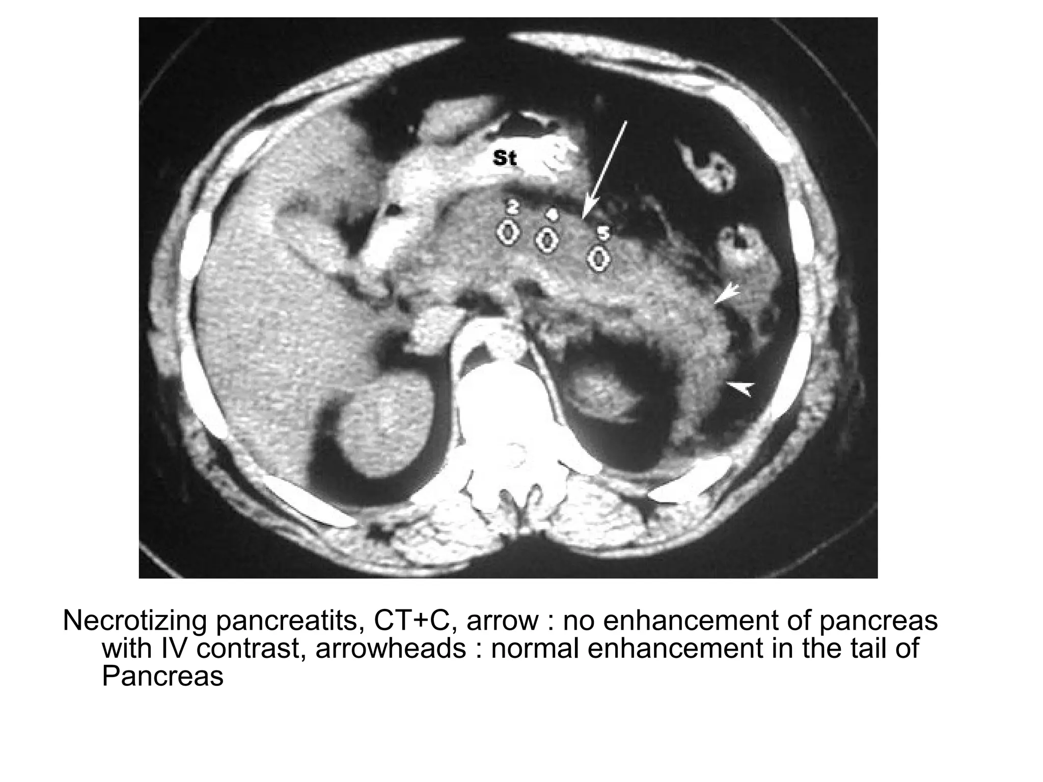 Diagnostic Imaging of Pancreatitis | PPT