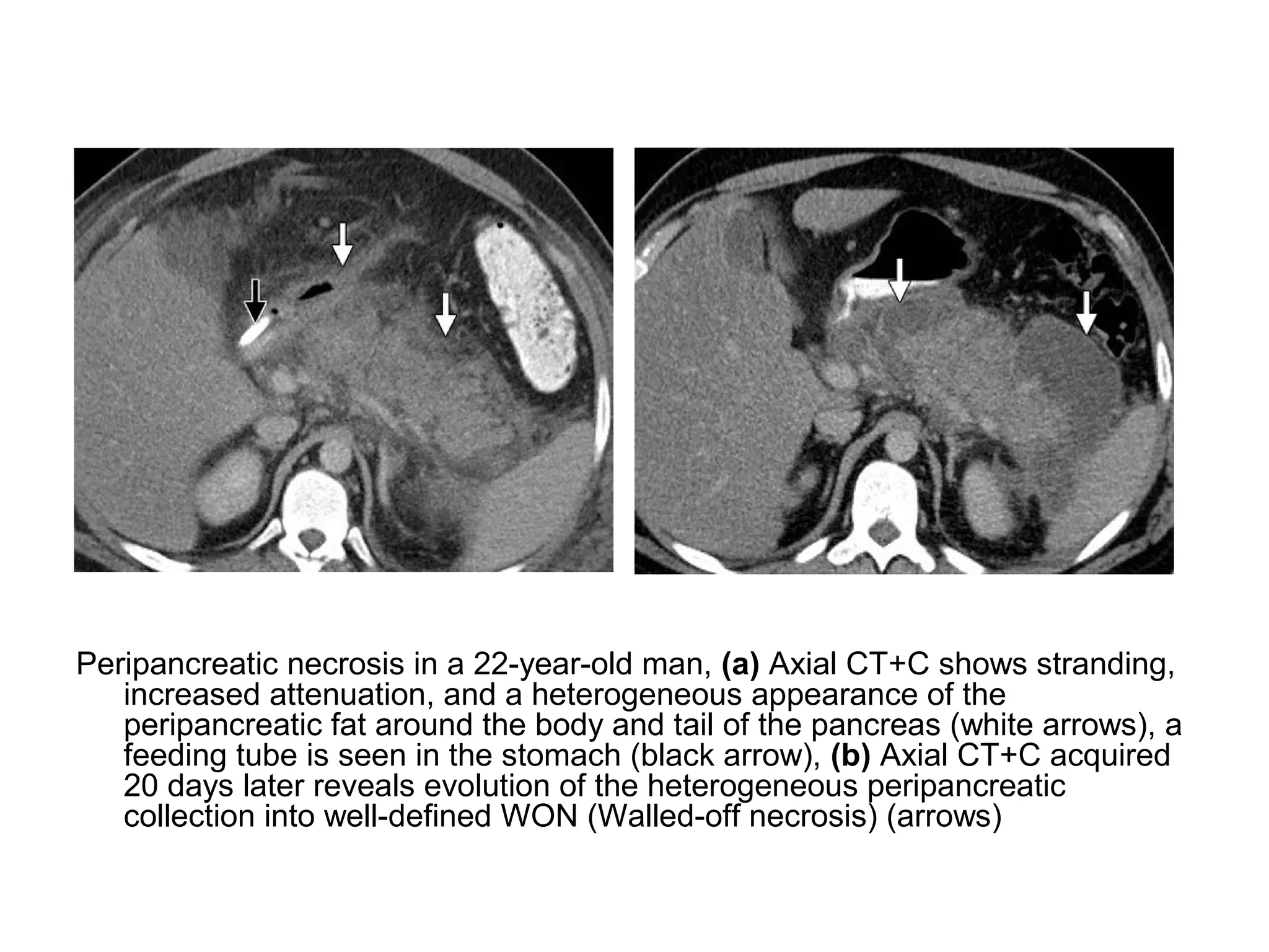 Diagnostic Imaging of Pancreatitis | PPT
