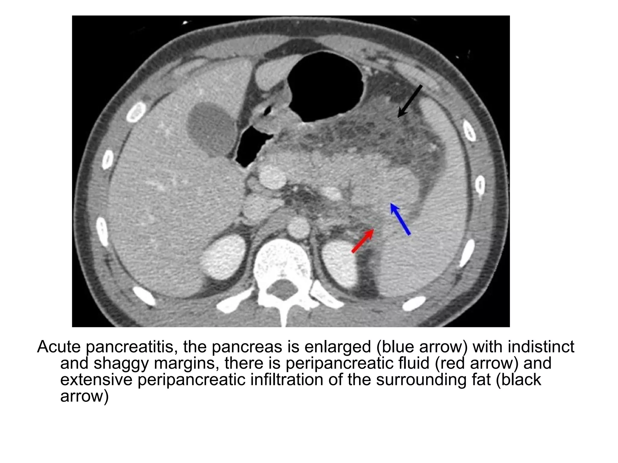 Diagnostic Imaging of Pancreatitis | PPT