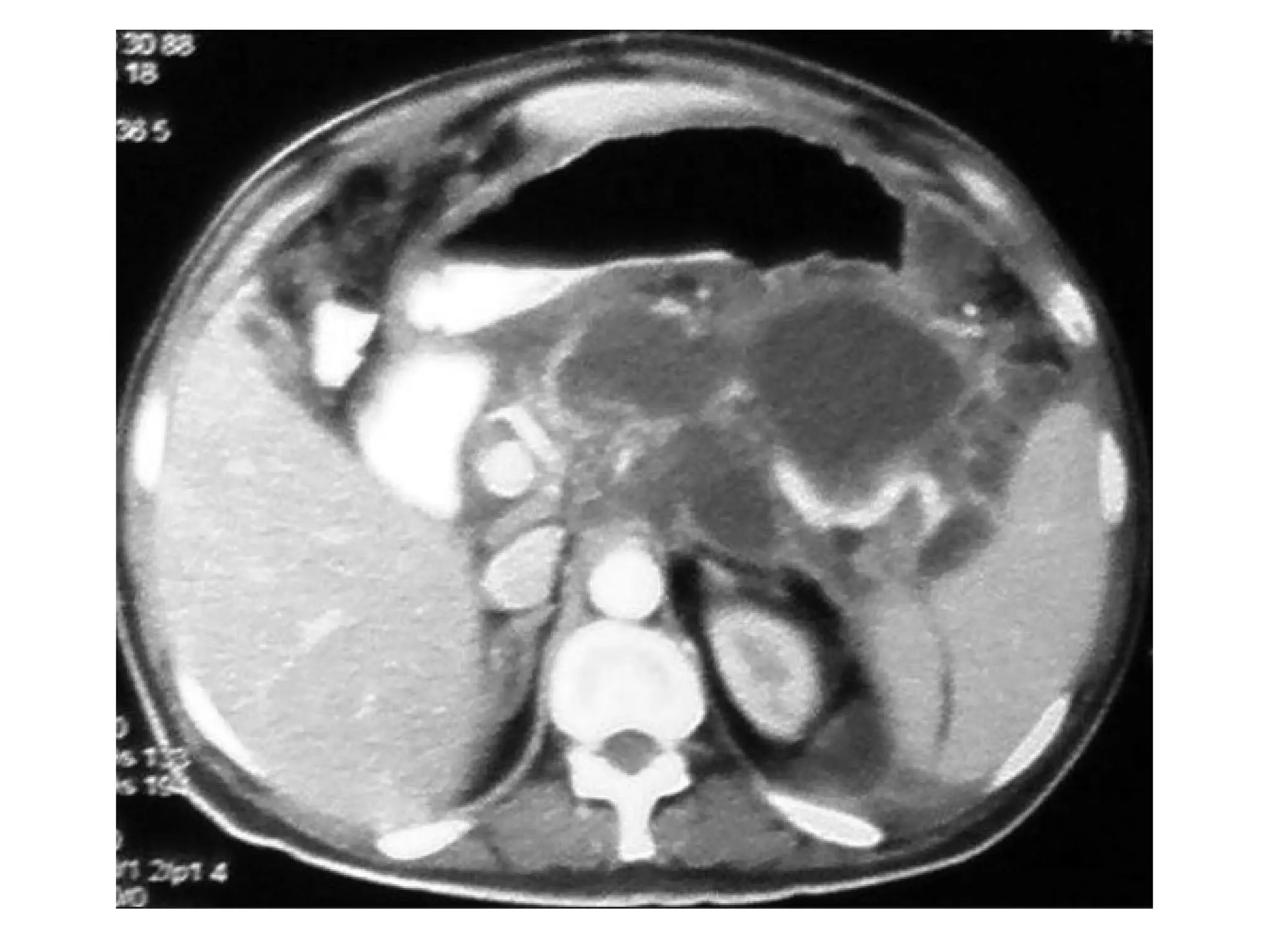 Diagnostic Imaging of Pancreatitis | PPT