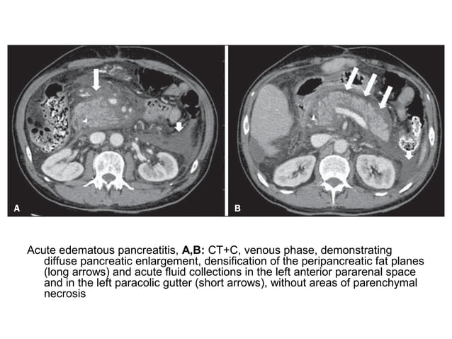 Diagnostic Imaging of Pancreatitis | PPT | Digestive Disorders ...