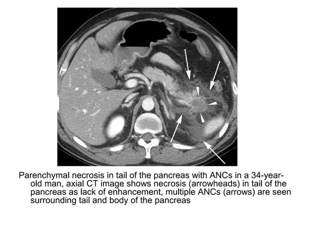Diagnostic Imaging of Pancreatitis | PPT | Digestive Disorders ...