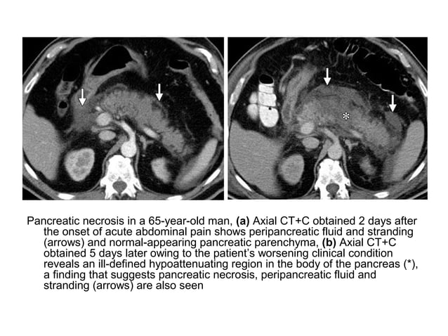Diagnostic Imaging of Pancreatitis | PPT | Digestive Disorders ...
