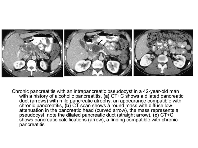 Diagnostic Imaging of Pancreatitis | PPT | Digestive Disorders ...
