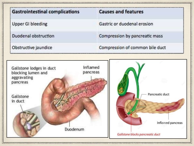 Pancreatitis