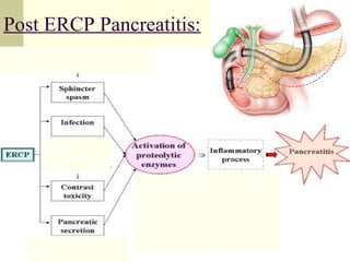 Pancreatitis | PPT