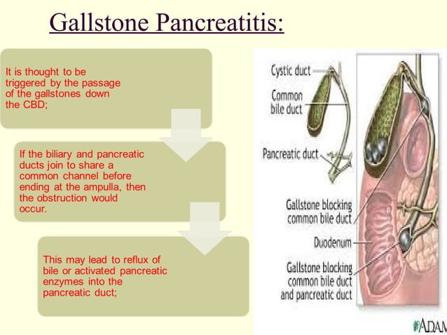 Pancreatitis