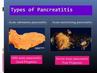 Pancreatitis | PPT