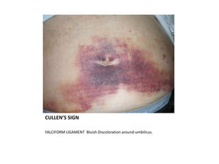 Pancreatitis | PPTX
