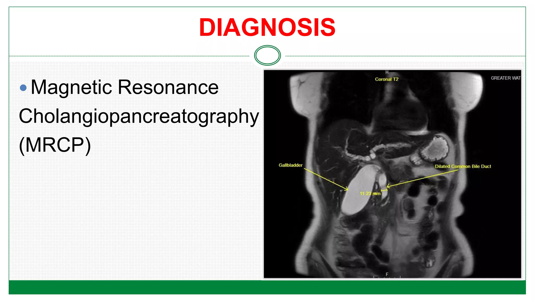 Pancreatitis topic for nursing students | PPTX