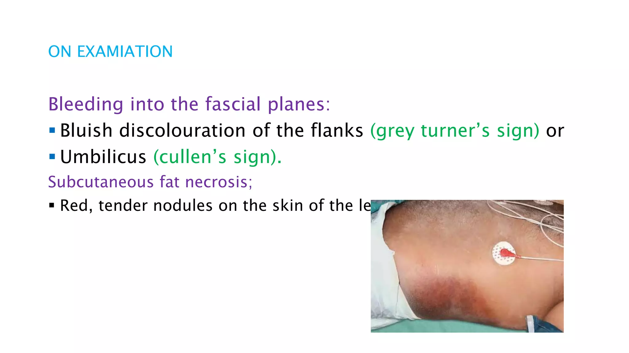 Acute Pancreatitis | PPTX