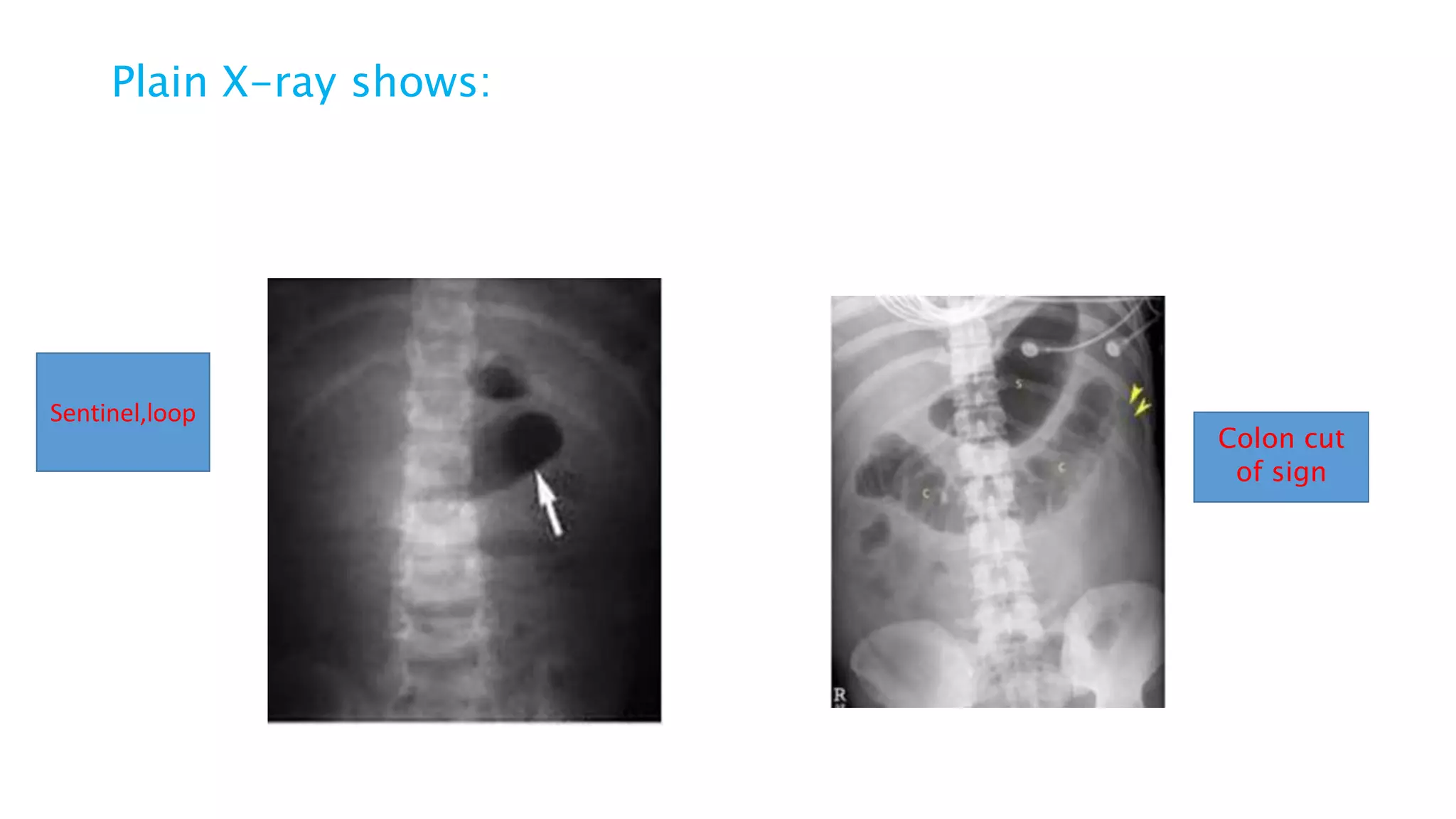 Acute Pancreatitis | PPTX
