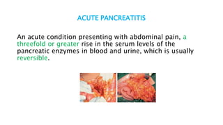 Acute Pancreatitis | PPTX