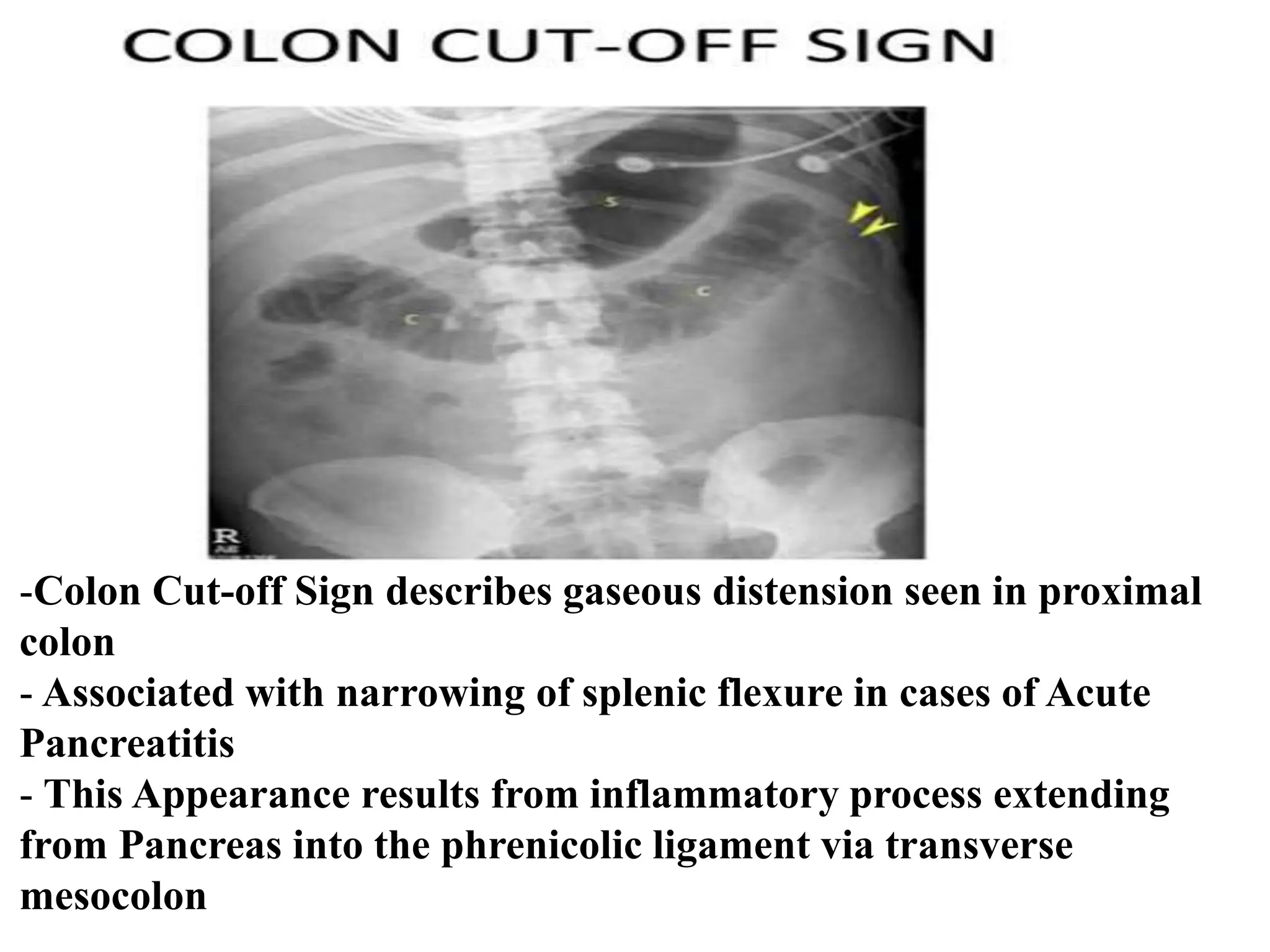 Pancreatitis DEFINITION, COMPLICATIONS, TREATMENT .pptx