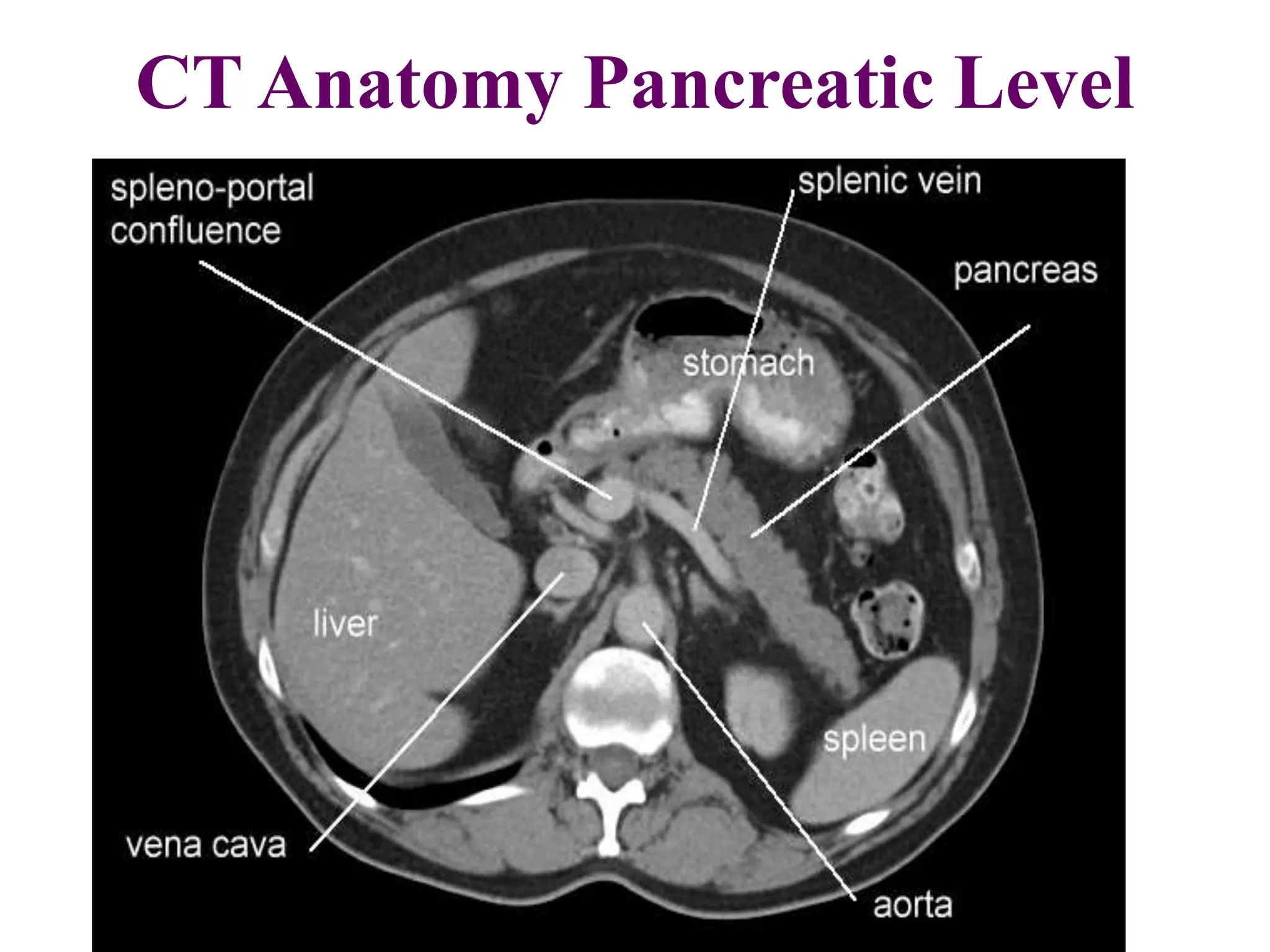Pancreatitis DEFINITION, COMPLICATIONS, TREATMENT .pptx