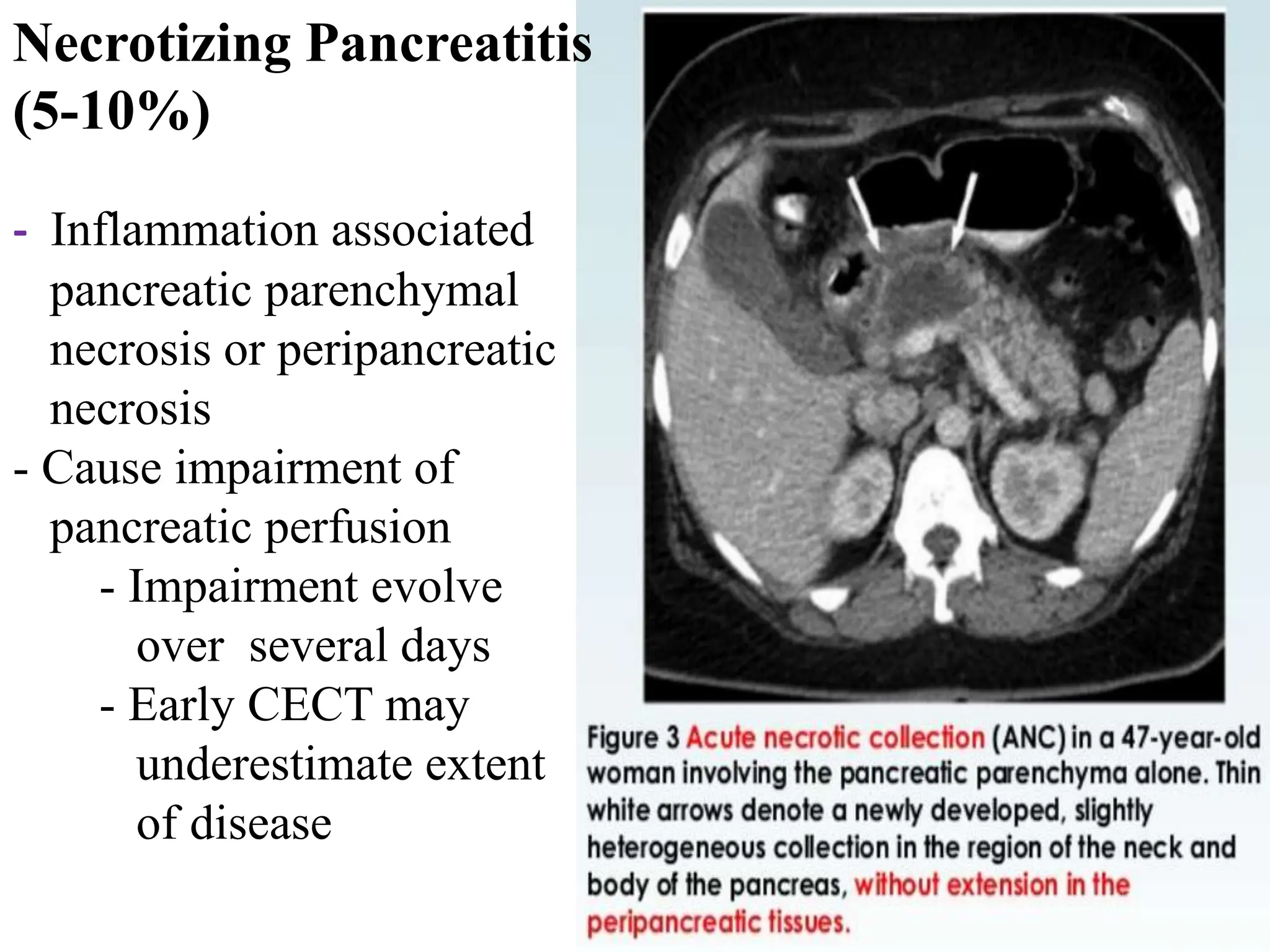 Pancreatitis DEFINITION, COMPLICATIONS, TREATMENT .pptx