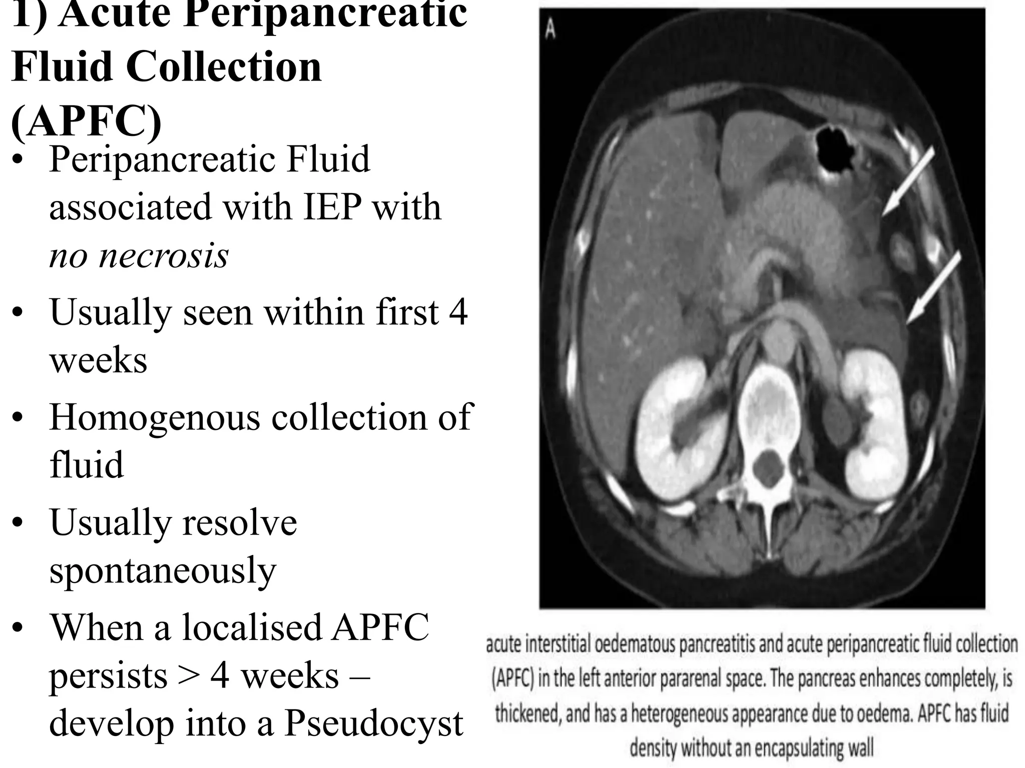 Pancreatitis DEFINITION, COMPLICATIONS, TREATMENT .pptx