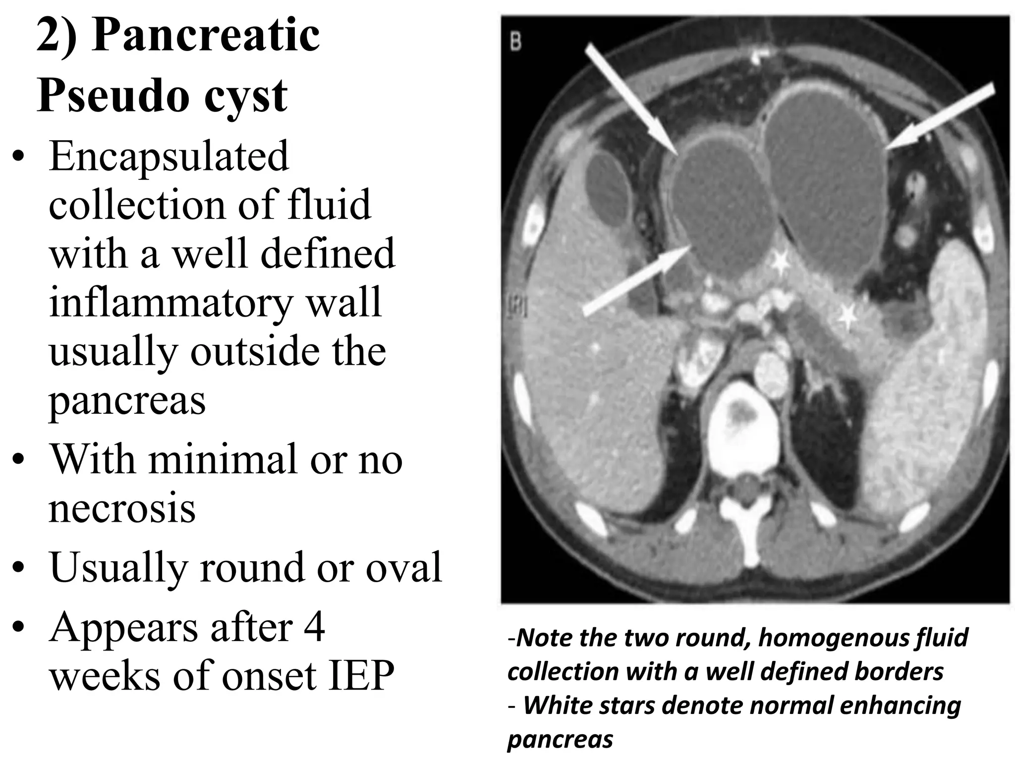 Pancreatitis DEFINITION, COMPLICATIONS, TREATMENT .pptx