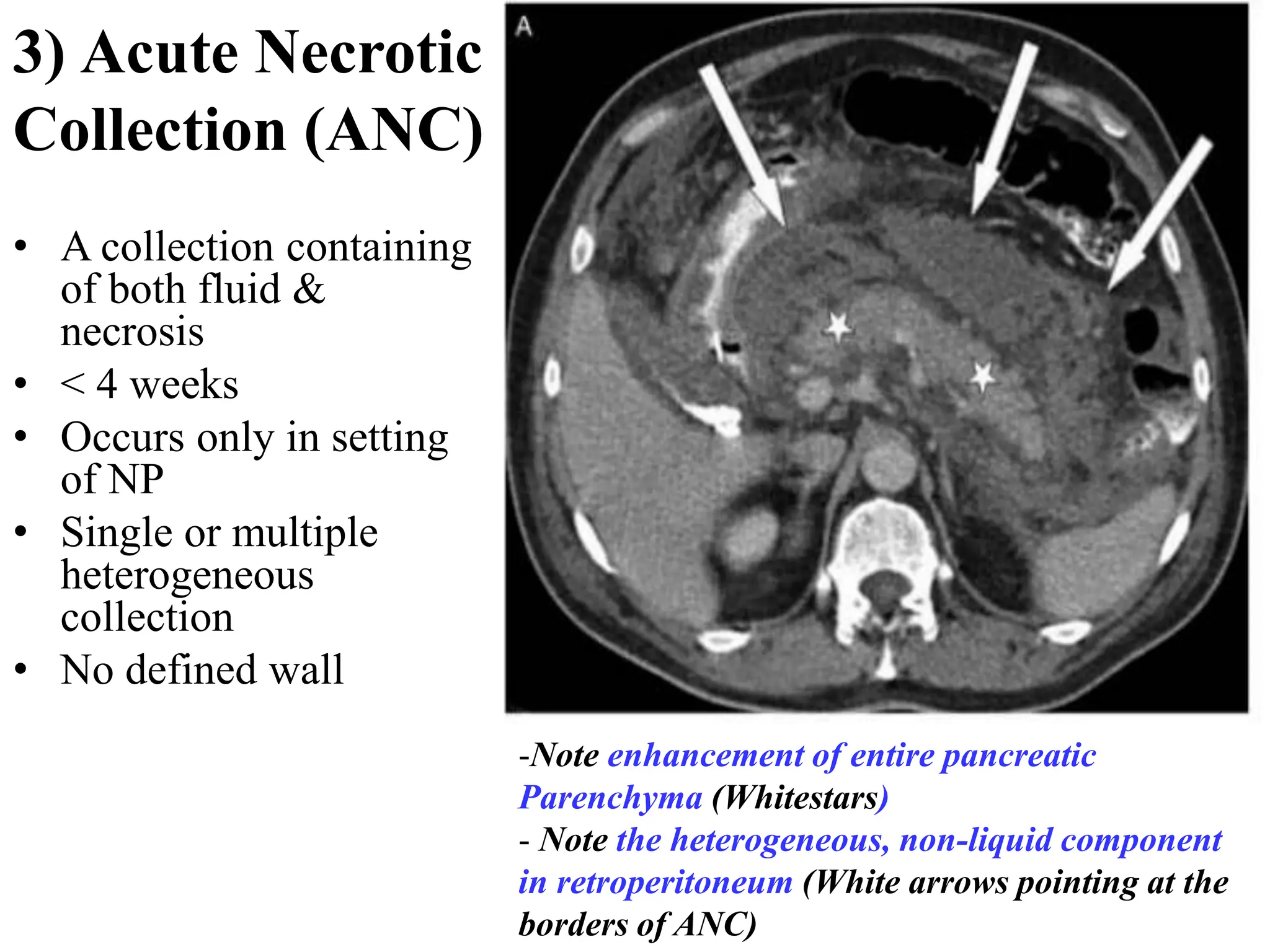 Pancreatitis DEFINITION, COMPLICATIONS, TREATMENT .pptx