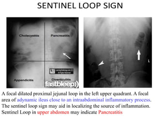 Pancreatitis DEFINITION, COMPLICATIONS, TREATMENT .pptx