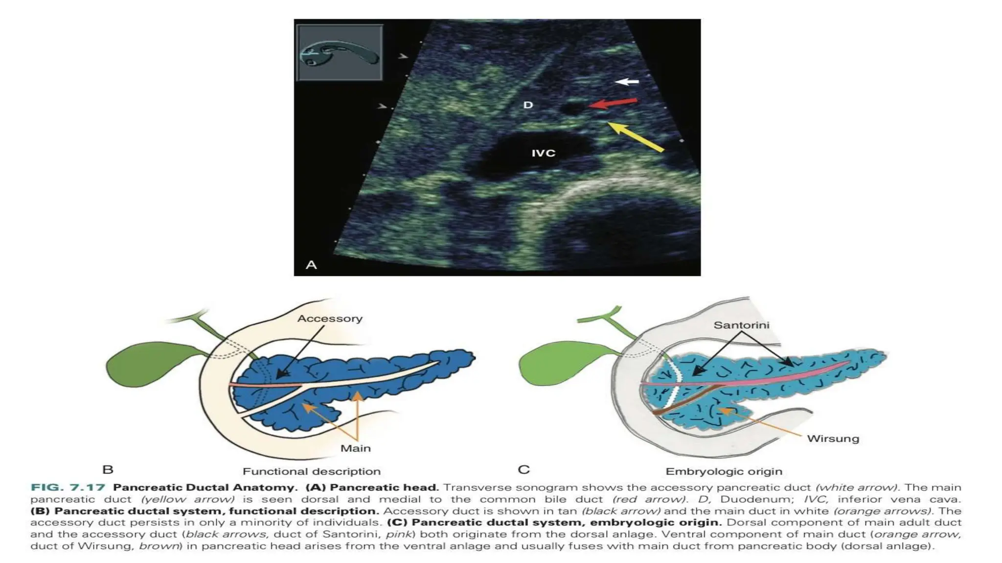 Sonological features of Pancreatitis.pptx