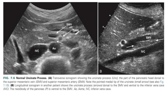 Sonological features of Pancreatitis.pptx
