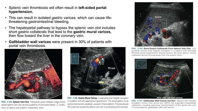 Sonological features of Pancreatitis.pptx