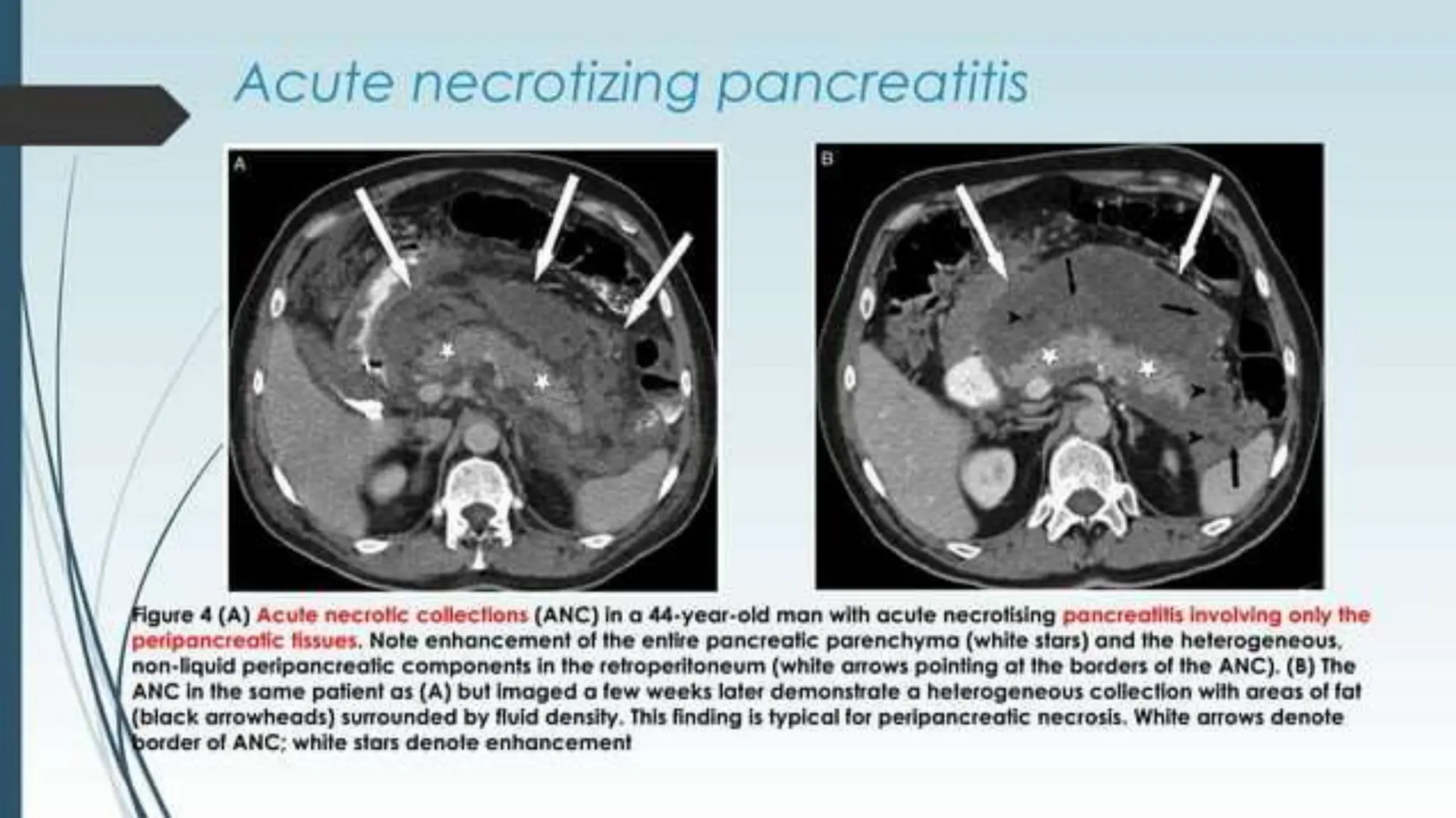 pancreatitis-presentation for nursing students | PPTX