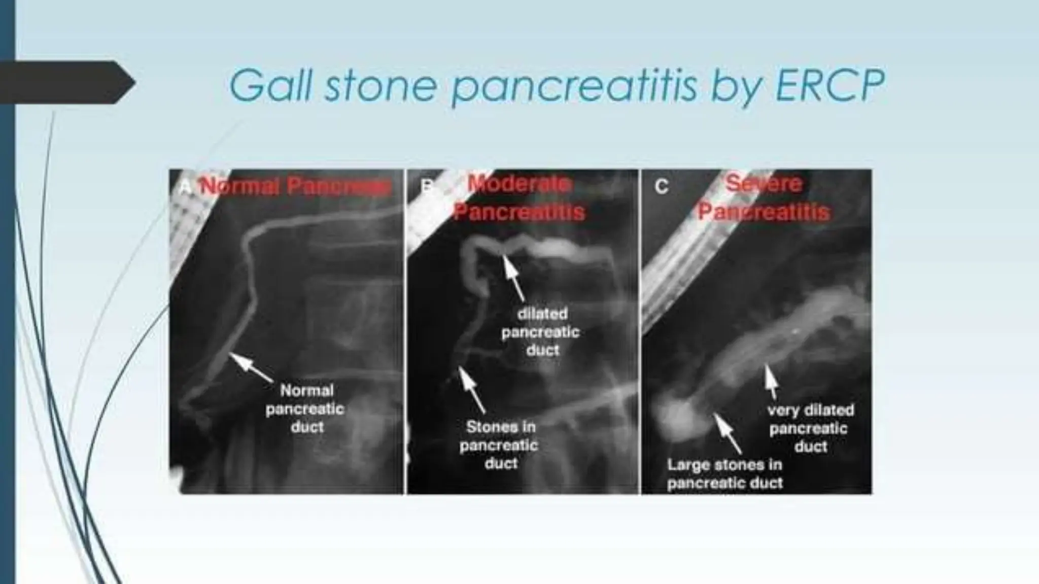 pancreatitis-presentation for nursing students | PPTX