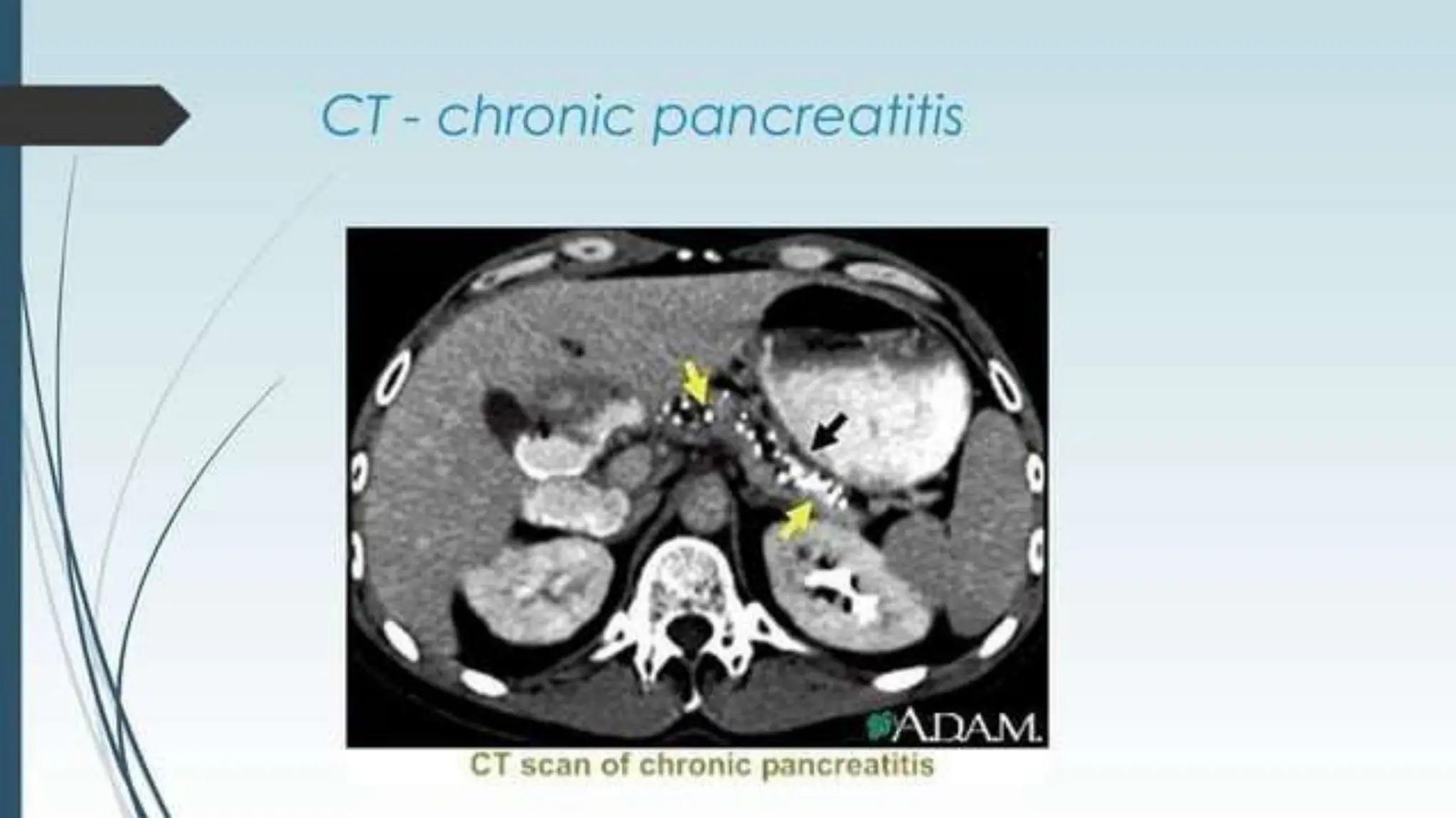 pancreatitis-presentation for nursing students | PPTX