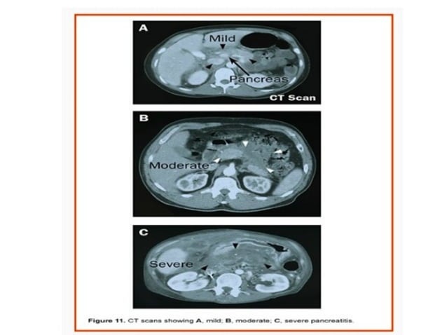 Acute pancreatis , inlamation of the pancrease | PPTX | Blood Disorders ...
