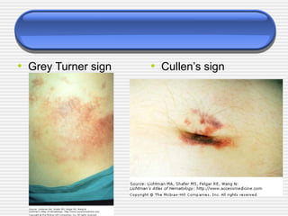 Acute and Chronic Pancreatitis diagnosis and ttt.ppt