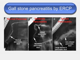 Acute and Chronic Pancreatitis diagnosis and ttt.ppt