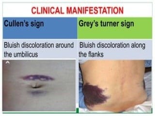 Pancreatitis disease process, pathophysiology and management | PPTX