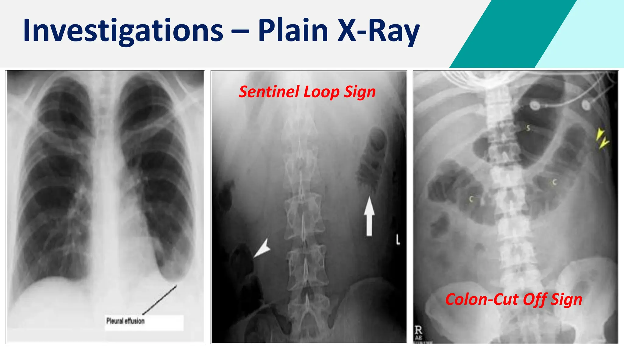 Pancreatitis - Acute & Chronic - Types, C/F & Mgt | PDF