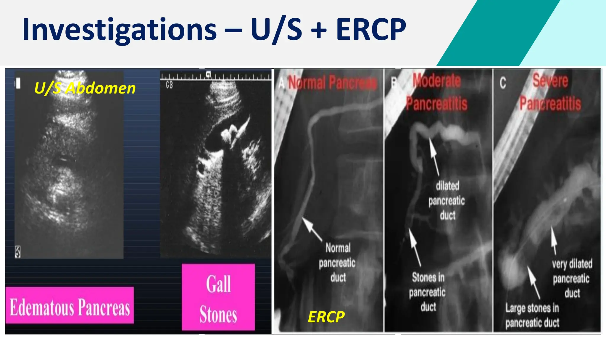 Pancreatitis - Acute & Chronic - Types, C/F & Mgt | PDF