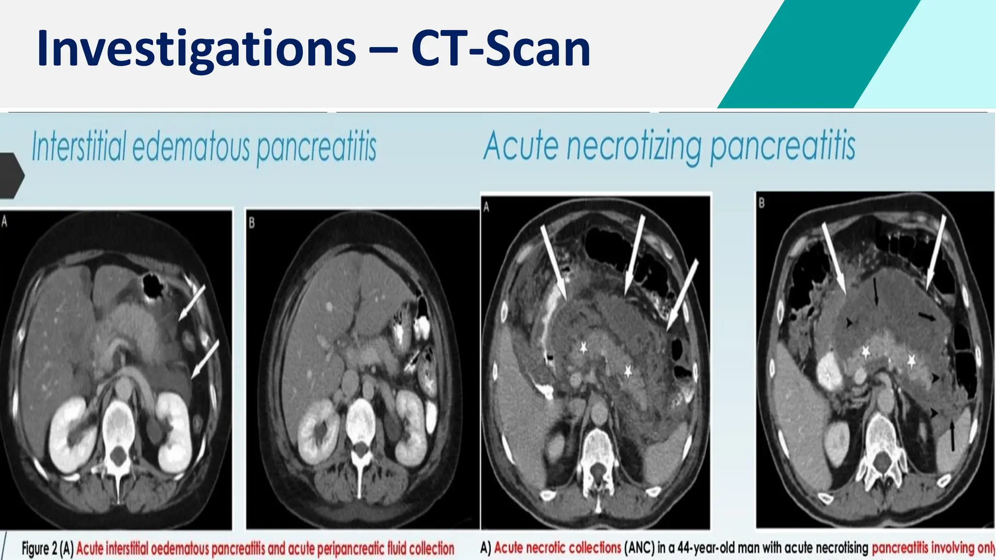 Pancreatitis - Acute & Chronic - Types, C/F & Mgt | PDF