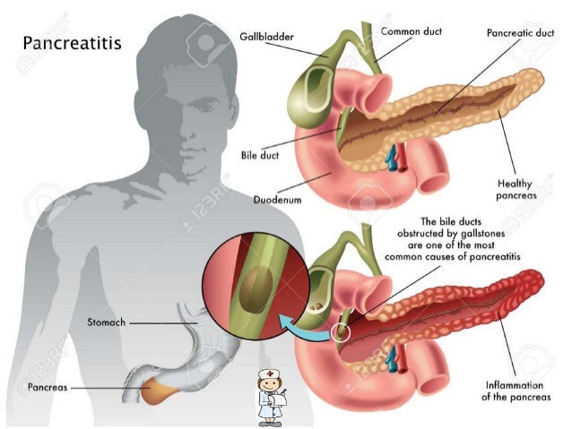 Pancreatitis final (1)