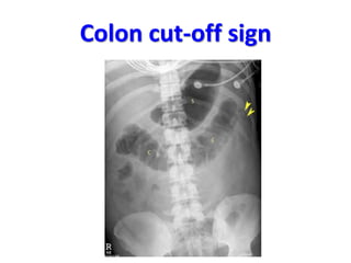 Colon Cutoff Sign