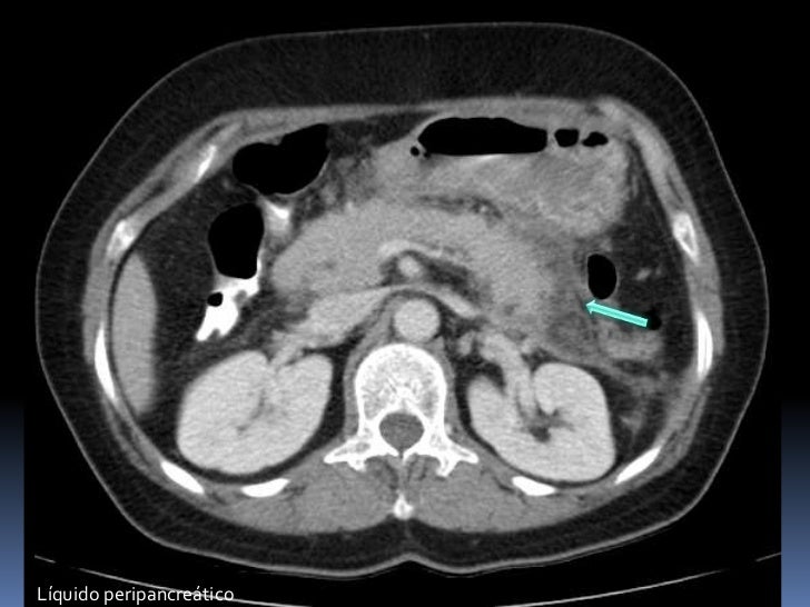 Hallazgos radiológicos en la Pancreatitis Aguda