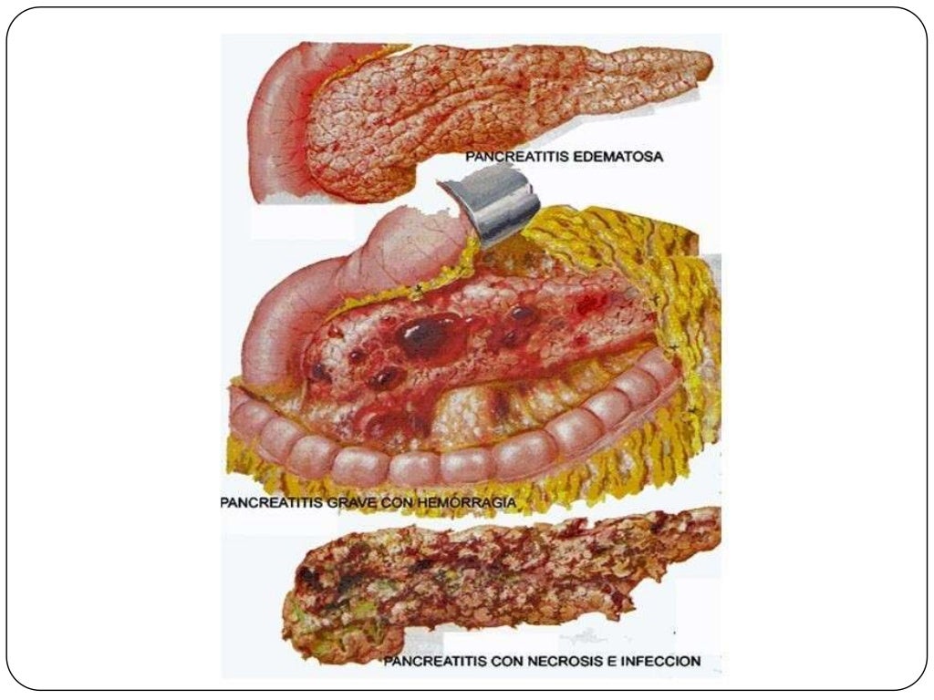 Pancreatitis aguda