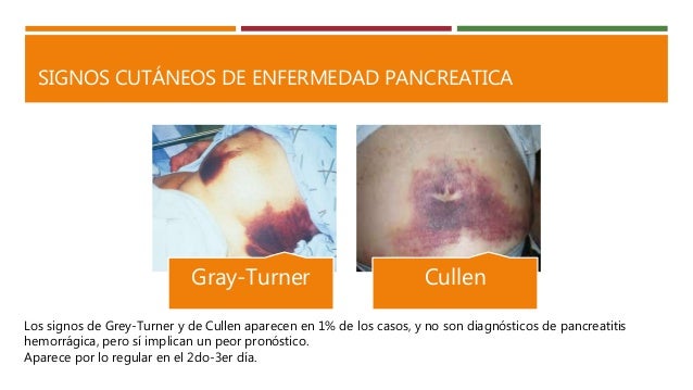 Pancreatitis aguda