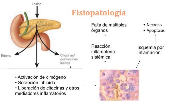 Pancreatitis Aguda