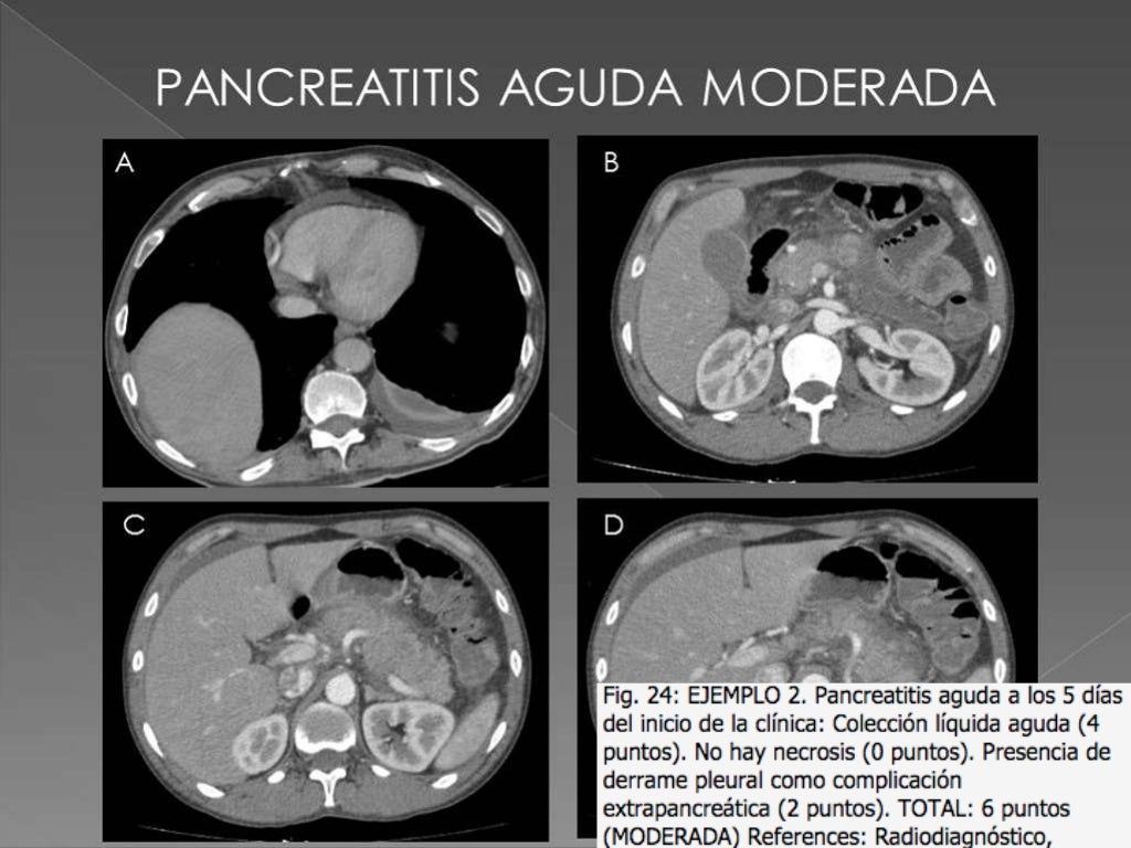 Pancreatitis Aguda Revision Atlanta 2012 Radiología