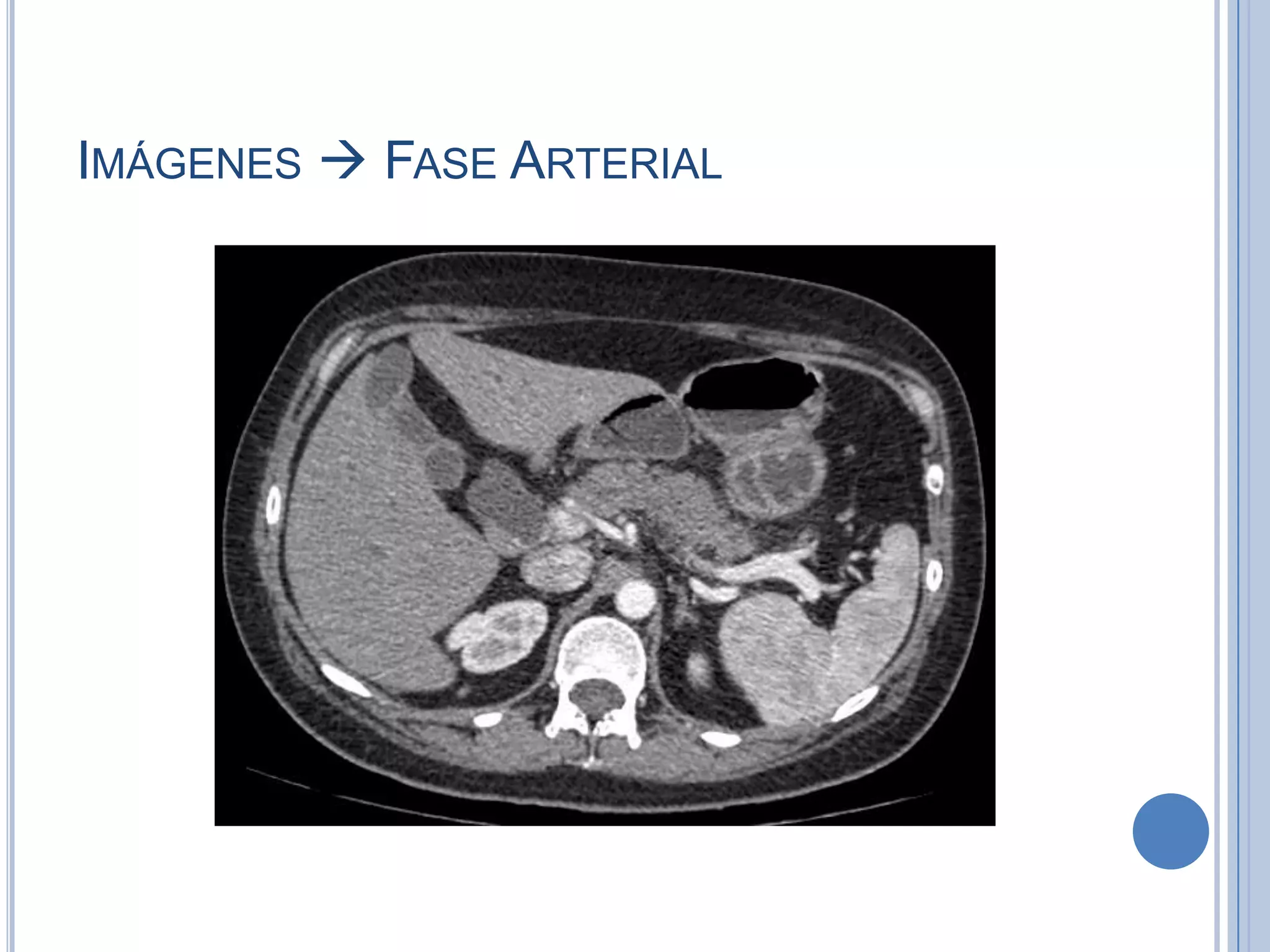 Pancreatitis aguda por TC | PPTX